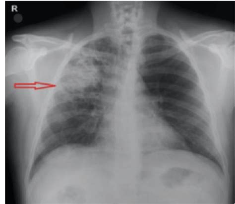 An Area Of Infiltration In The Upper Zone Of The Right Lung On Pa Chest