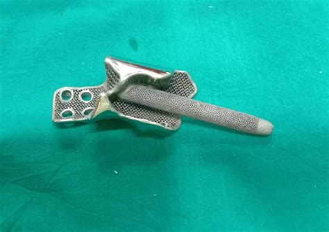 Custom Tibia Implant For Complex Tibial Reconstruction Jajal Medical