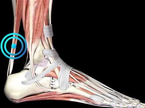 Tendinitis Del Ligamento Inguinal Tendinitis One