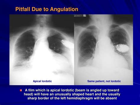 What Is Apico Lordotic Means Missed Lung Cancer When Where And Why