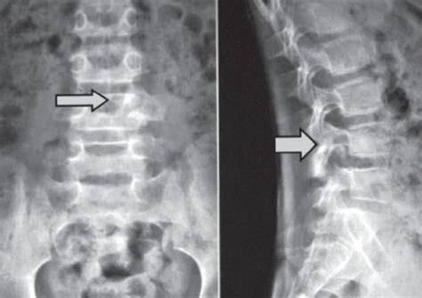 Osteoblastoma Spine