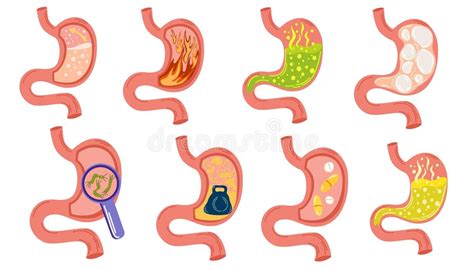 Heartburn Process Stock Illustrations 52 Heartburn Process Stock