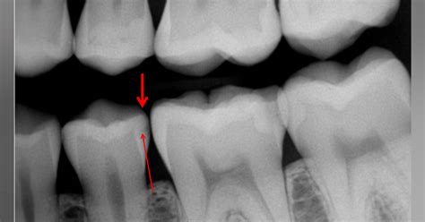 What Are The Best Procedures For Composite Tooth Preparations Dental