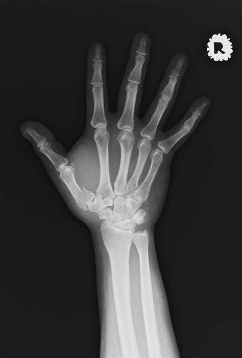 Closed Fracture Of Right 1st Proximal Metacarpal Uni Clinic