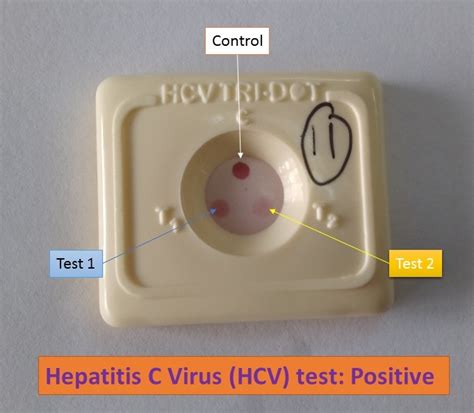 Hcv Test Positive Introduction Principle Procedure Result