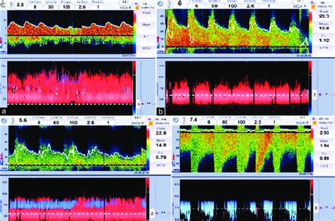 Local Hemodynamics In A Patient With Carotid Occlusion Before And After Download Scientific