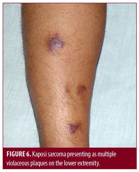 Fronek Figure6 Jcad The Journal Of Clinical And Aesthetic Dermatology