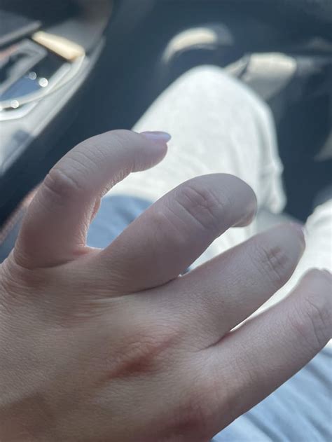 Bug Bite Id Rbugidentification