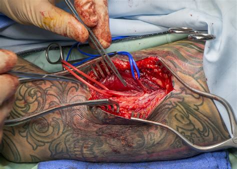 Radial Nerve Decompression Orthoracle Luanmd