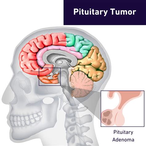 Pituitary Gland Tumor Symptoms In Women Pituitary Tumor North