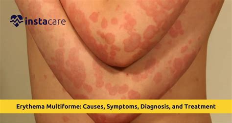Erythema Multiforme Causes Symptoms Rash And Treatment