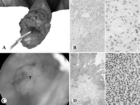Squamous Cell Carcinoma Bladder Gross