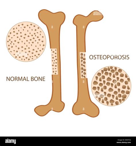 Osteomalacia Bone