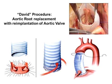 Aortic Root