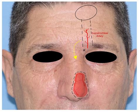 Paramedian Forehead Flap The A Point Represents The Pivotal Point For