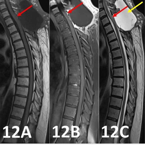 Axial T1 Post Contrast Mri Image At The T1t2 Vertebral Level Note The