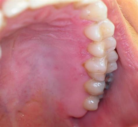 Oral Herpes Rash At Jacqueline Gean Blog