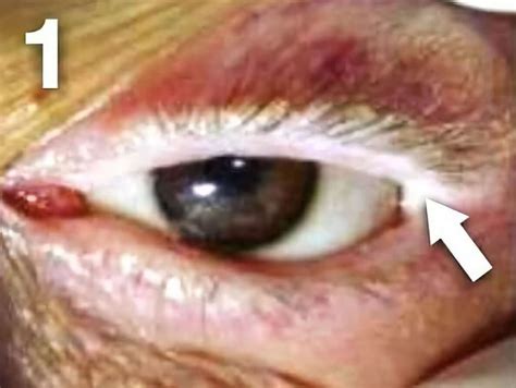 Resus Drills Lateral Canthotomy — Em3