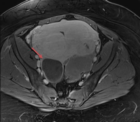 Do Mri Structured Reports With Figo Classifications Of Leiomyomas