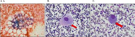 A Bone Marrow Aspiration Prels40x B And C Bone Marrow Aspiration