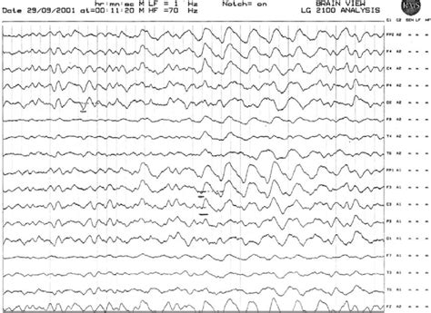 Eeg Showing Intermittent Delta Activity And Triphasic Waves Download Scientific Diagram