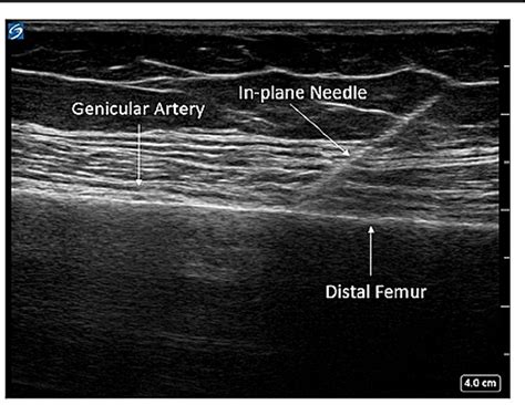 Figure 1 From Comparison Of Genicular Nerve Block In Combination With