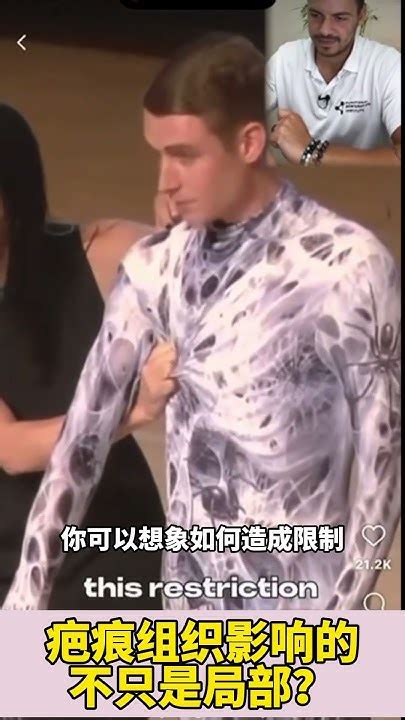 你知道吗？疤痕组织影响的，不只是局部 Youtube