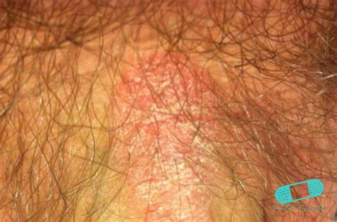Genital Psoriasis Online Dermatology