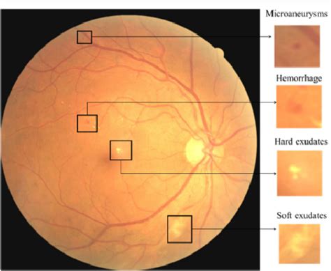 Detecting Diabetic Retinopathy Severity Through Fundus Images Using An Ensemble Of Classifiers