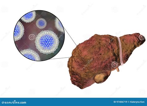 Fígado Com Infecção Da Hepatite C Ilustração Stock Ilustração De