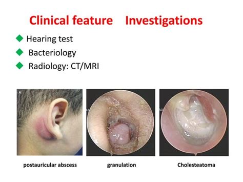 Otitis Media Is The Internal Infection Of Ear Which Causes Swelling Of