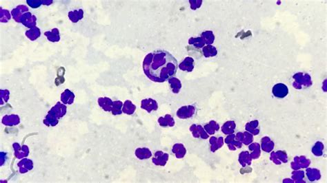 Degenerate Neutrophils Eclinpath 52 Off
