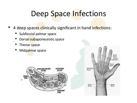 Deep Space Amp Collar Button Infections Hand Orthobullets Nonoperative