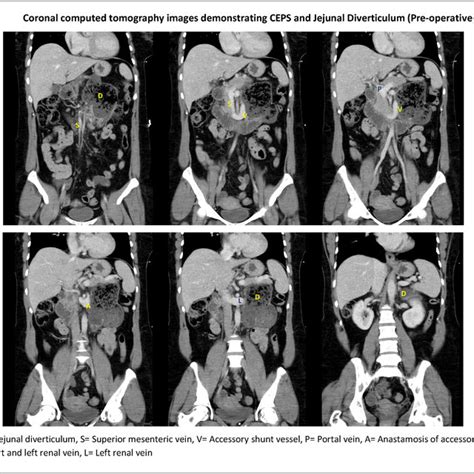Schematic Examples Of Abernethy Malformation Under The Classification