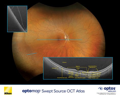 Diagnostic And Educational Tools For Optomap Access Materials