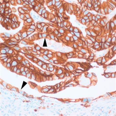 Incomplete Lateralbasolateral Membrane Staining Produc Open I