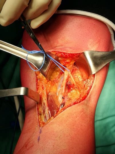 Pigmented Villonodular Synovitis