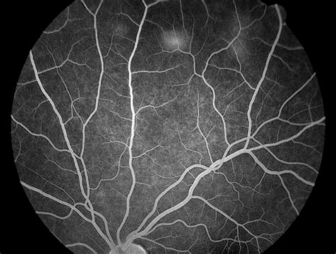 Syphilitic Multifocal Retinitis Retinal Angiography Shows Download Scientific Diagram