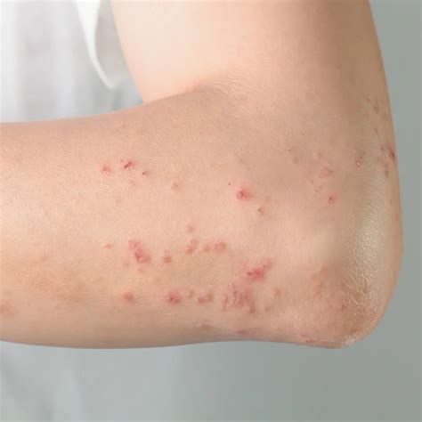 Dermatology Rash Treatment When To Seek Expert Medical Care