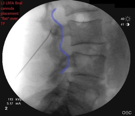 Fluoroscopic Guided Cervical Medial Branch Radiofrequency Ablation
