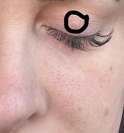 Is This A Chalazion Rblepharitis