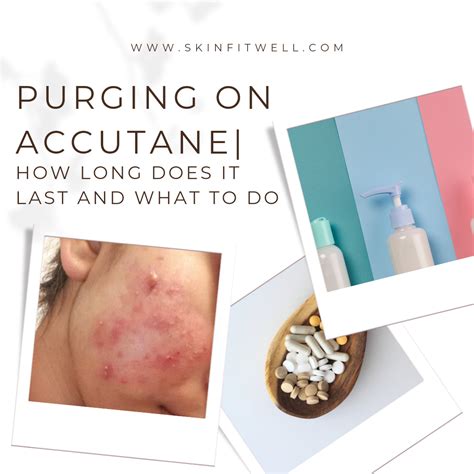 How Long Does Purging Last On Accutane Skin Fit Well Skin Fit Well