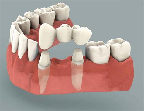 Dental Bridge Procedure Dental Bridge Vs Dental Implant