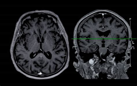 160 Cerebral Atrophy Foto Stok Potret And Gambar Bebas Royalti Istock