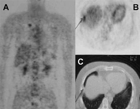 A Uptake Suggestive Of Malignancy In The Previous Bullectomy Site Of Download Scientific