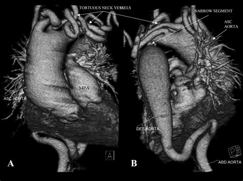 Arterial Tortuosity Syndrome Circulation