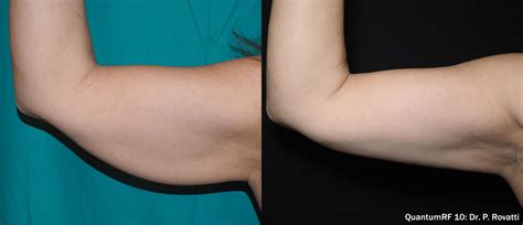 Quantum Rf Body Contouring Alo Medical Leesburg Fl