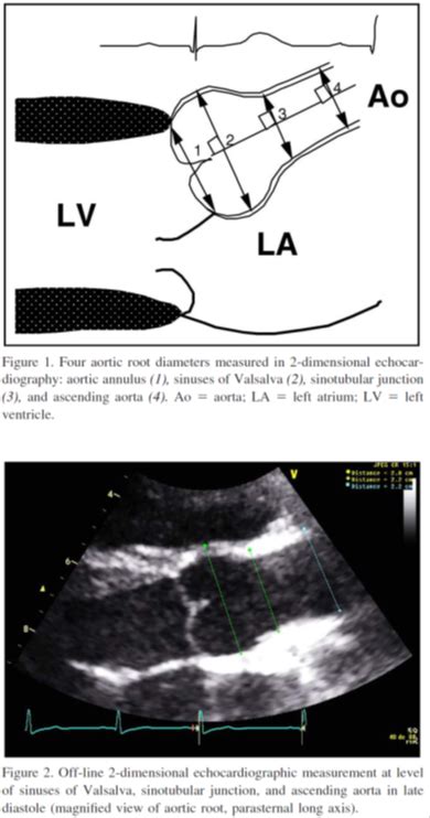 Pedi Cardiology Aortic Root Normal Values Nomogram