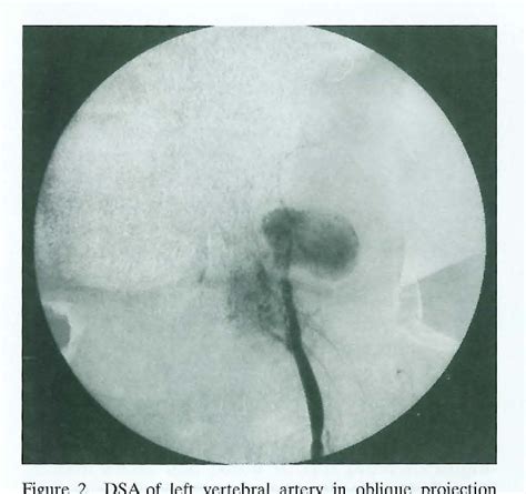 Figure 2 From Extracranial Vertebral Artery Pseudoaneurysm Due To