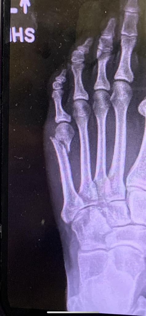 Shoe Recommendations Post Metatarsal Surgery Rfootfunction